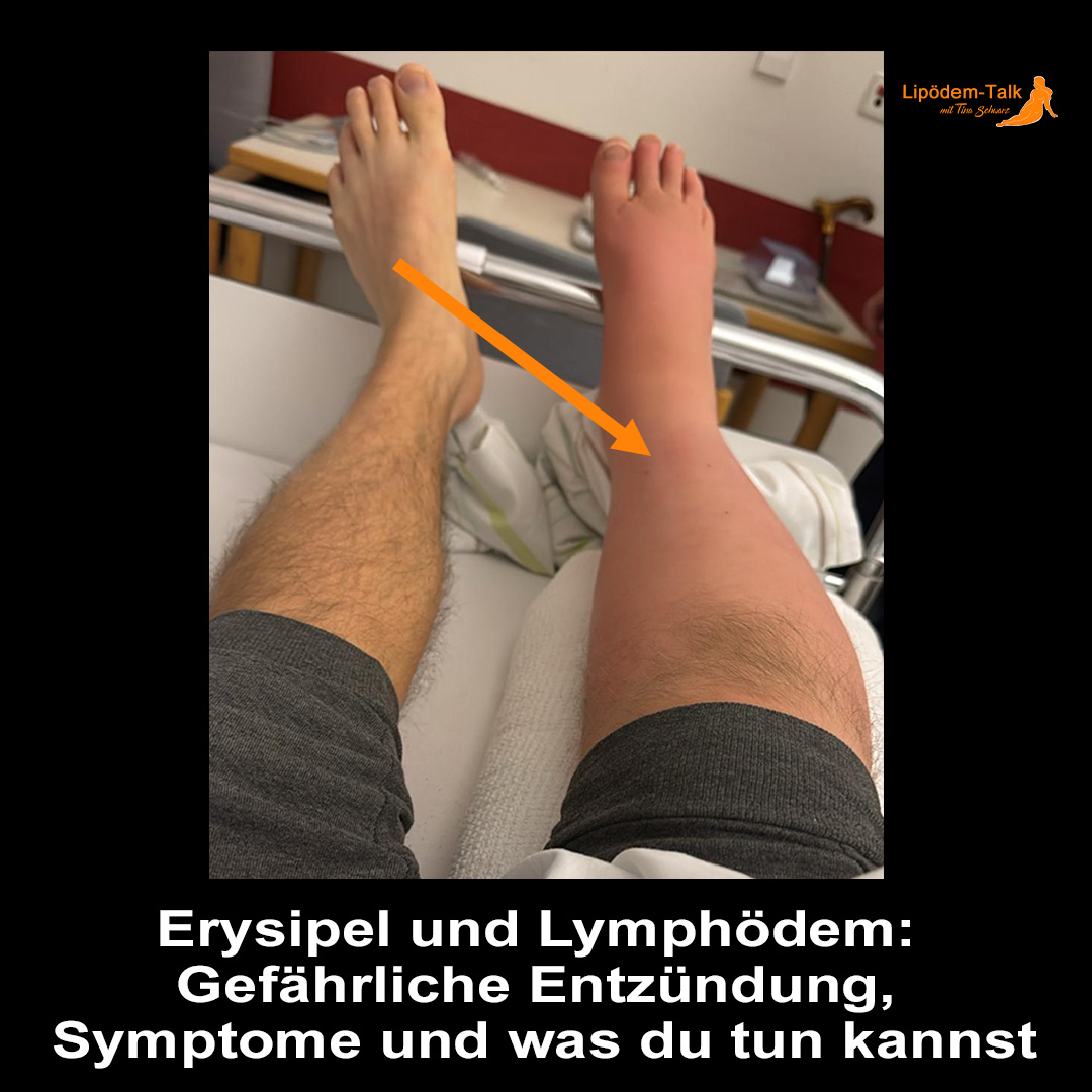 Erysipel und Lymphödem - Gefährliche Entzündung, Symptome und was du ...